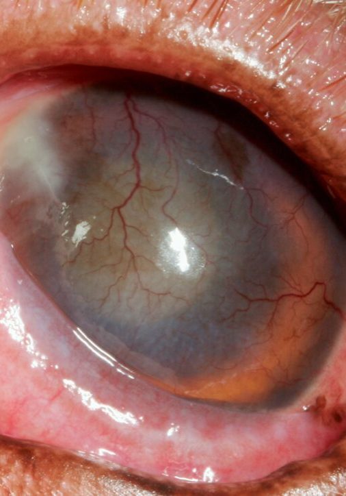 Dry Eye | Willows UK | West Midlands